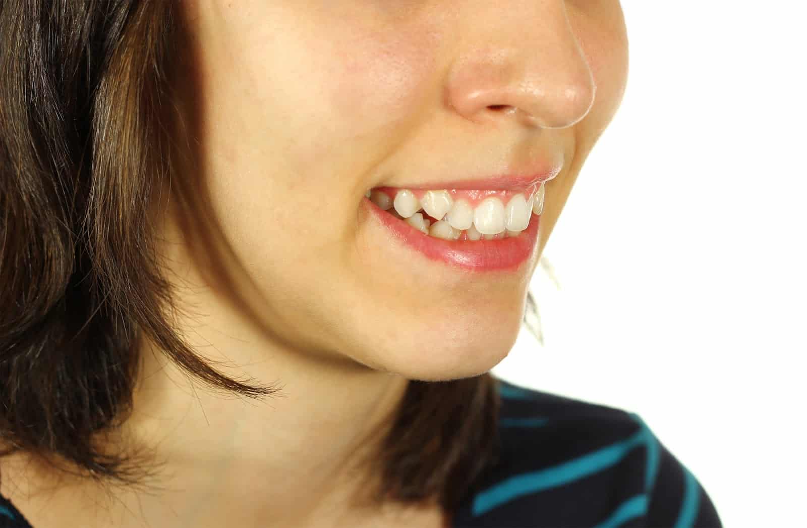 3 Treatments for Slightly Crooked Teeth Dr Hardt